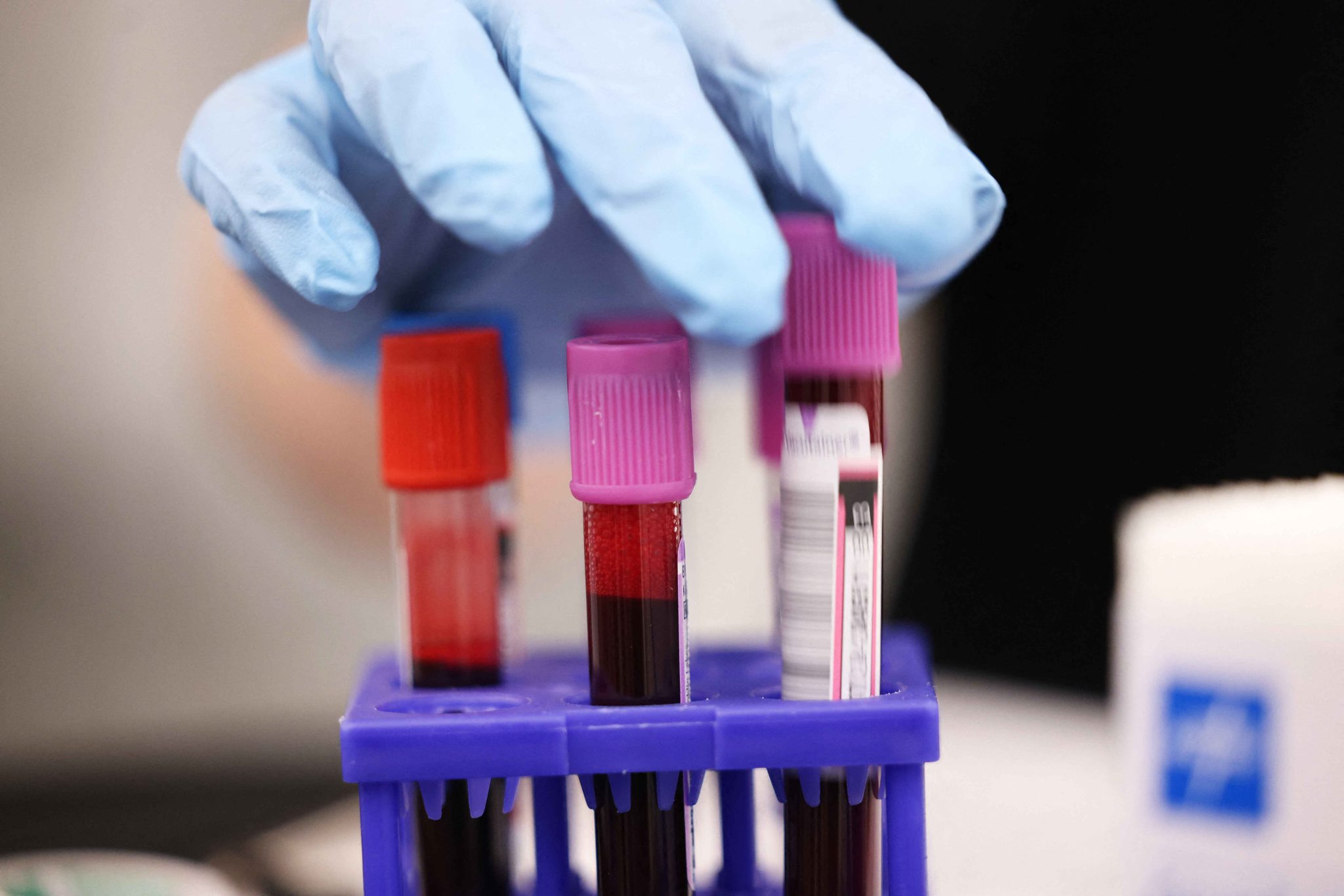 How a new AI blood test is ending the era of “silent” liver disease ...
